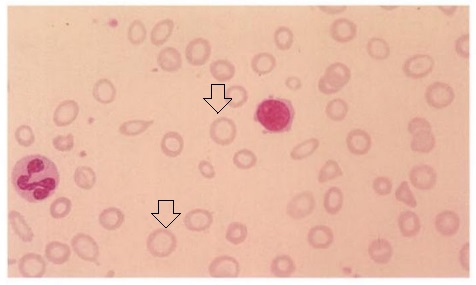 FICHERO HEMATOLOGIA : Eritrocito hipocrómico
