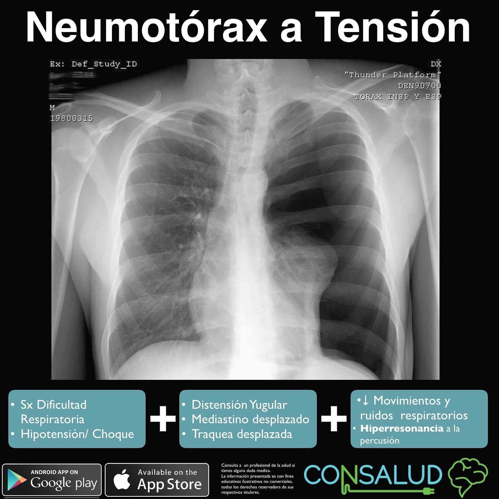 Neumotórax A Tensión De Descompresión Con Aguja