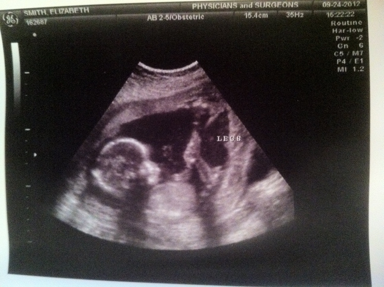 Out of the Blue: 17 Week Update and Anatomy Ultrasound