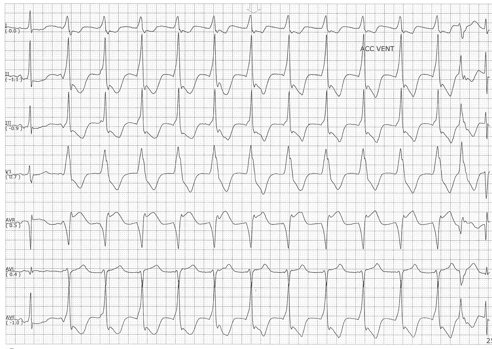 Sinus Rhythm Changing to AIVR