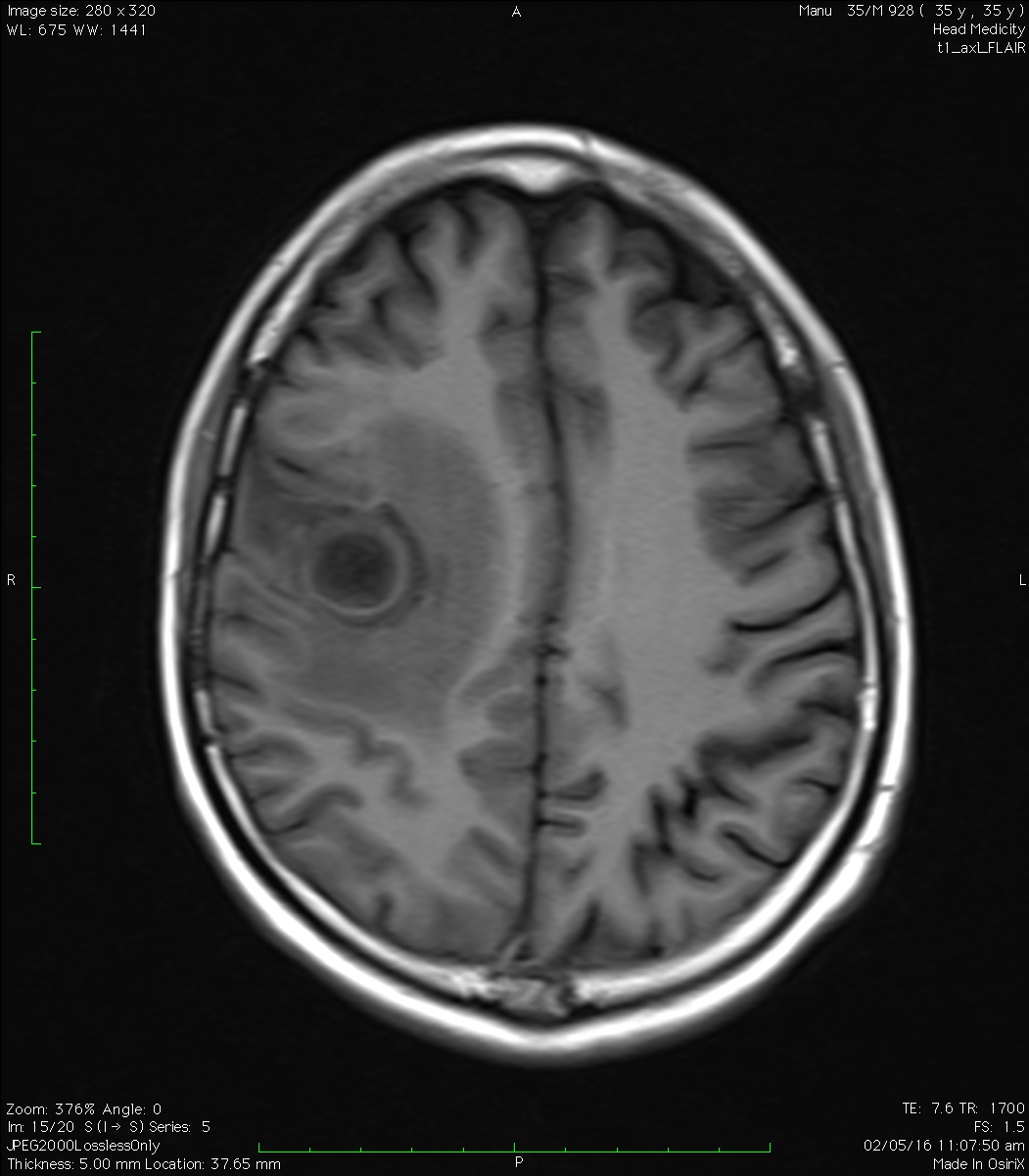 Ultimate Radiology : Frontal lobe abscess : follow up MRI