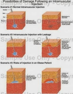 INJEKSI (PARENTERAL) | Karyaku Bicara