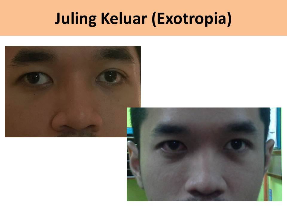 azzifaruN Nurafizza: Juling Air