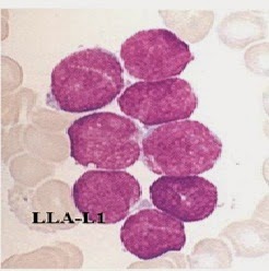 Fichero de hematología. Células sanguíneas.: Leucemia linfoide aguda