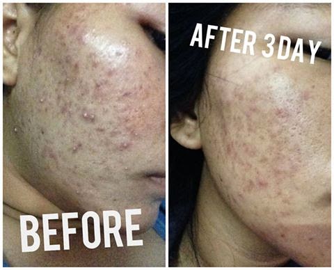 Thailand Beauty Products: Before And After Using Freshy Face Gold Set