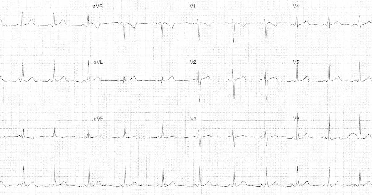 ECG of the Week: ECG of the Week - 25th June 2018 - Interpretation