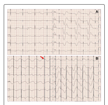 Journals and Conferences on Cardiology: Failure of Ventricular Capture ...