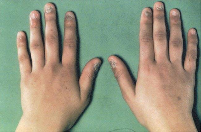 ADDISON'S DISEASE: CAUSES, RISKS, DIAGNOSIS & TREATMENT ...