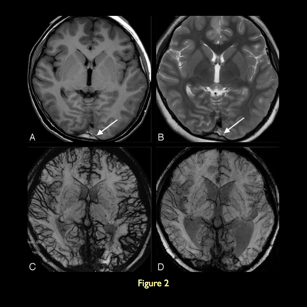 MRI BLOG: Susceptibility Weighted Imaging (II/II) - Image Gallery