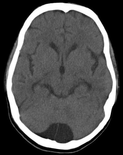 Dr Balaji Anvekar FRCR: Giant Cisterna Magna