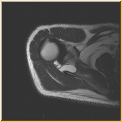 Spinoglenoid Notch Ganglion Cyst-MRI - Sumer's Radiology Blog