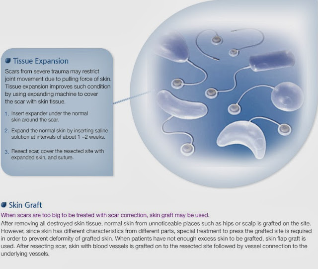 BK Plastic Surgery: [BK Plastic Surgery] Scar Revision Methods