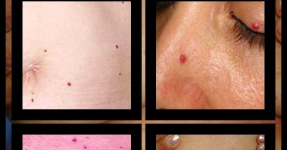 Estética e Autoestima: O Que São Hemangioma ou Angioma Rubi