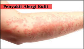 Mengenali Berbagai Jenis Alergi | Tips Pola Hidup Sehat Yang Benar