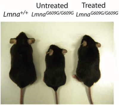 progeria family circle: gene therapy for children with progeria