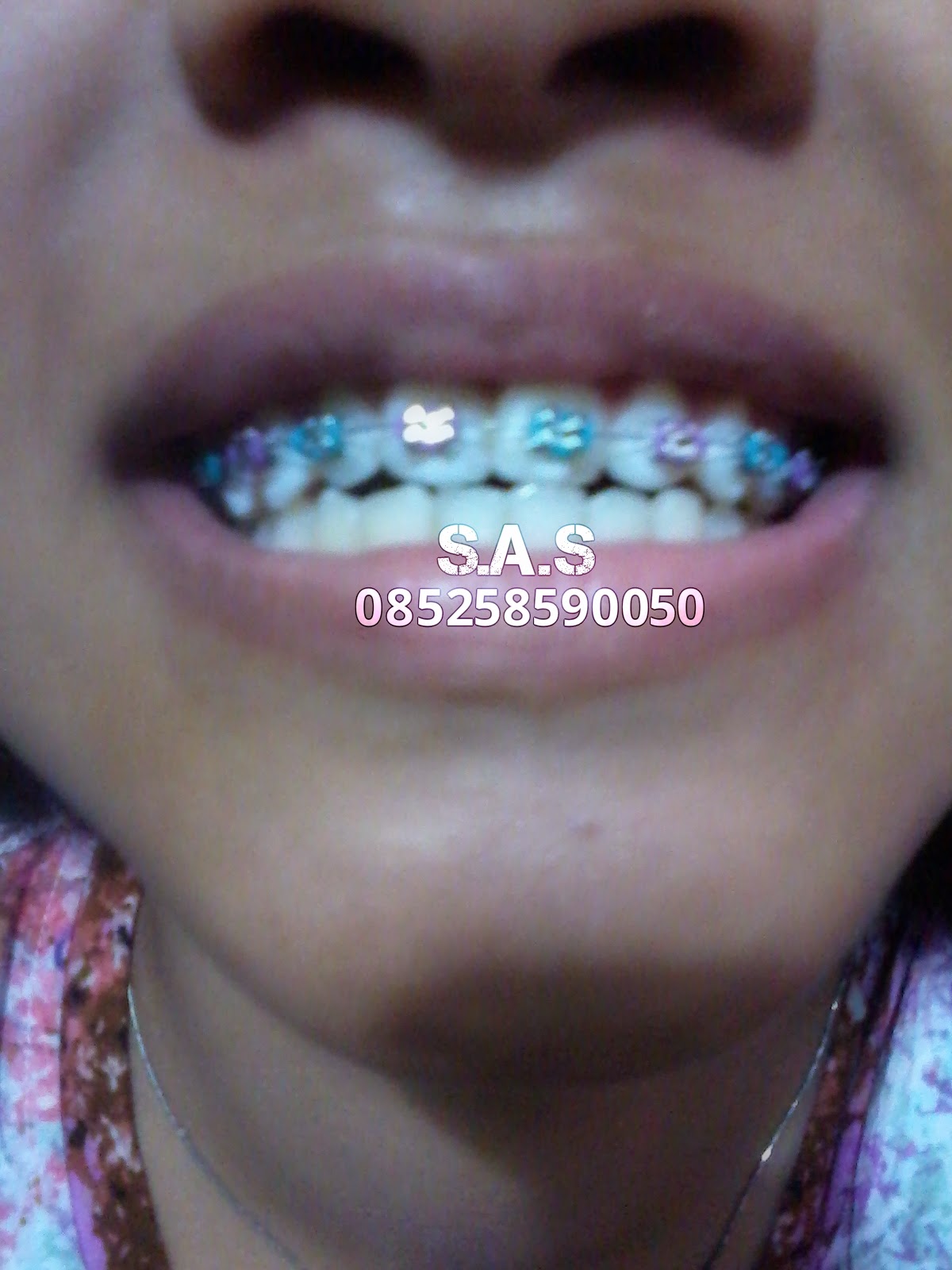 Dari yang Kurang Rapi Menjadi Lebih Rapi :)) |Tukang Gigi AHLI GIGI JEMBER