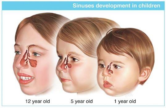 Sheelu Srinivas - ENT Practice: Sinusitis in children