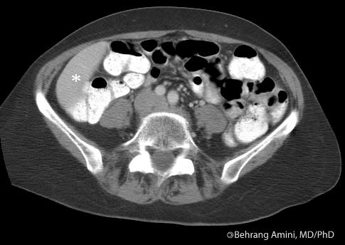 Roentgen Ray Reader: Riedel's Lobe of the Liver
