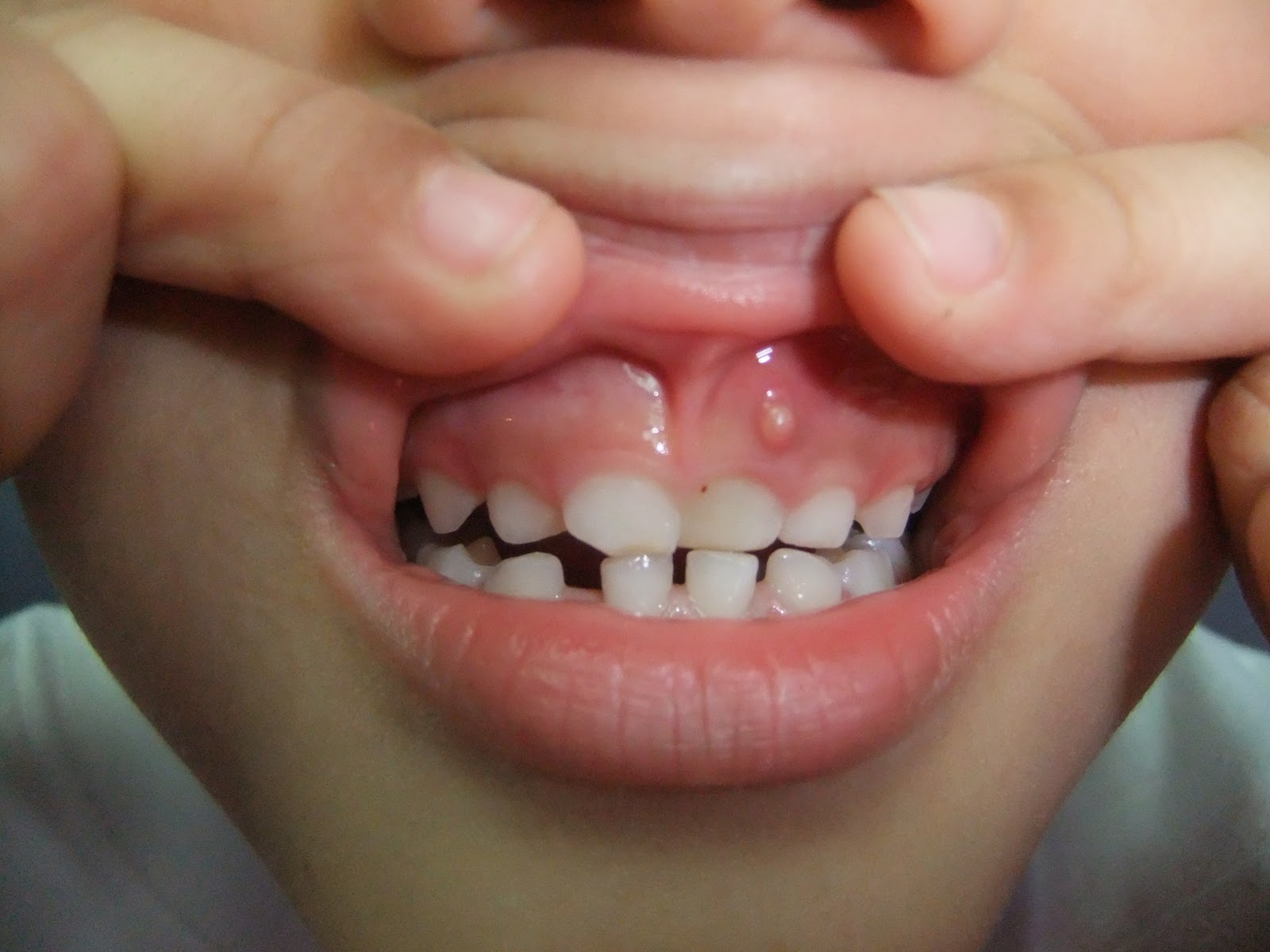 Prayers, Hugs & Diapers: Traumatized Tooth