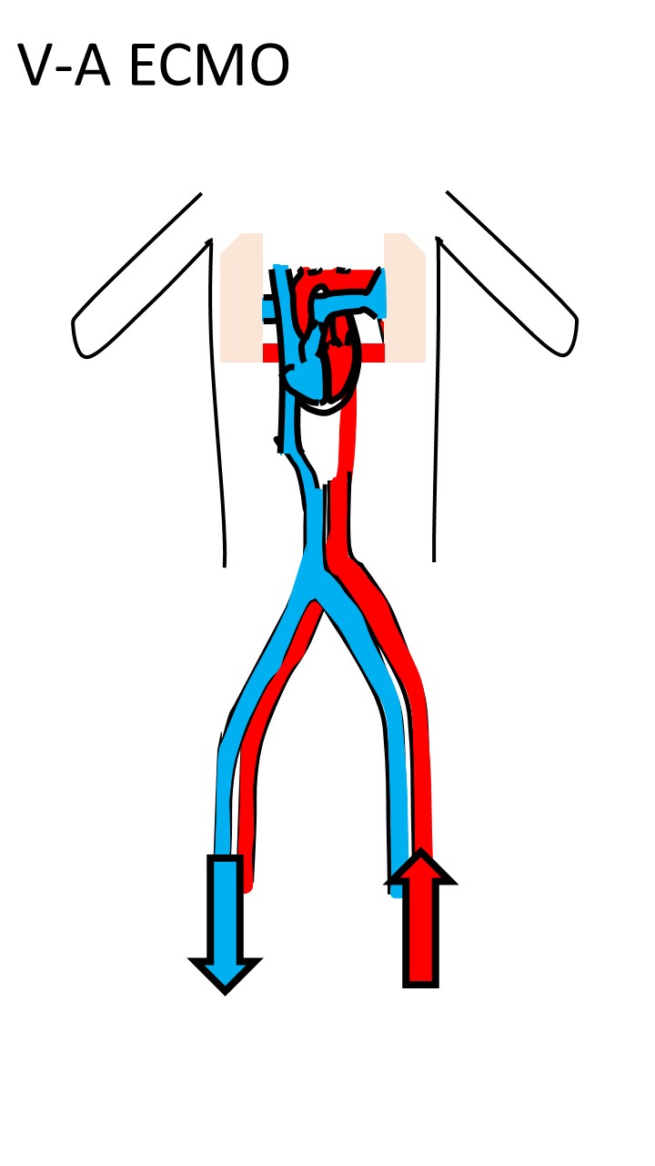 ECMO（PCPS）の基本原理と観察項目-臨床工学技士による呼吸療法勉強会