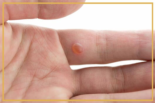 The Everything Health Blog: Types Of Warts You Need To Know About