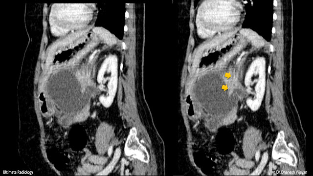 Ultimate Radiology : Pancreatic pseudocyst with duct communication (CT)