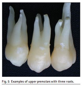 Endodontic: MAXILLARY FIRST PREMOLAR