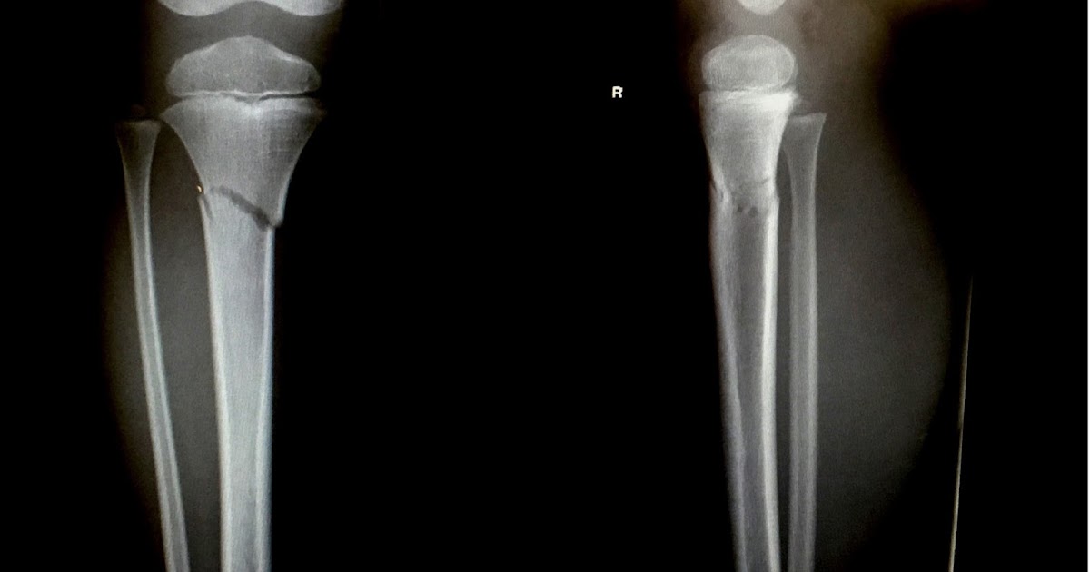 BEINBRUCH] über sich hinauswachsen - oder wie wird man ACHTZIG ...