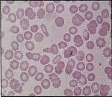 Células importantes en hematología: EQUINOCITOS