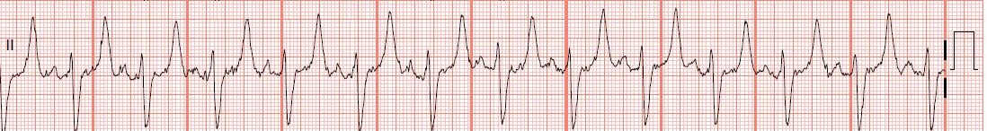 Float Nurse: EKG Rhythm Strips: Hyperkalemia part 3