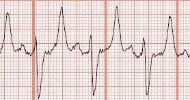 EKG Rhythm Strips: Hyperkalemia part 3
