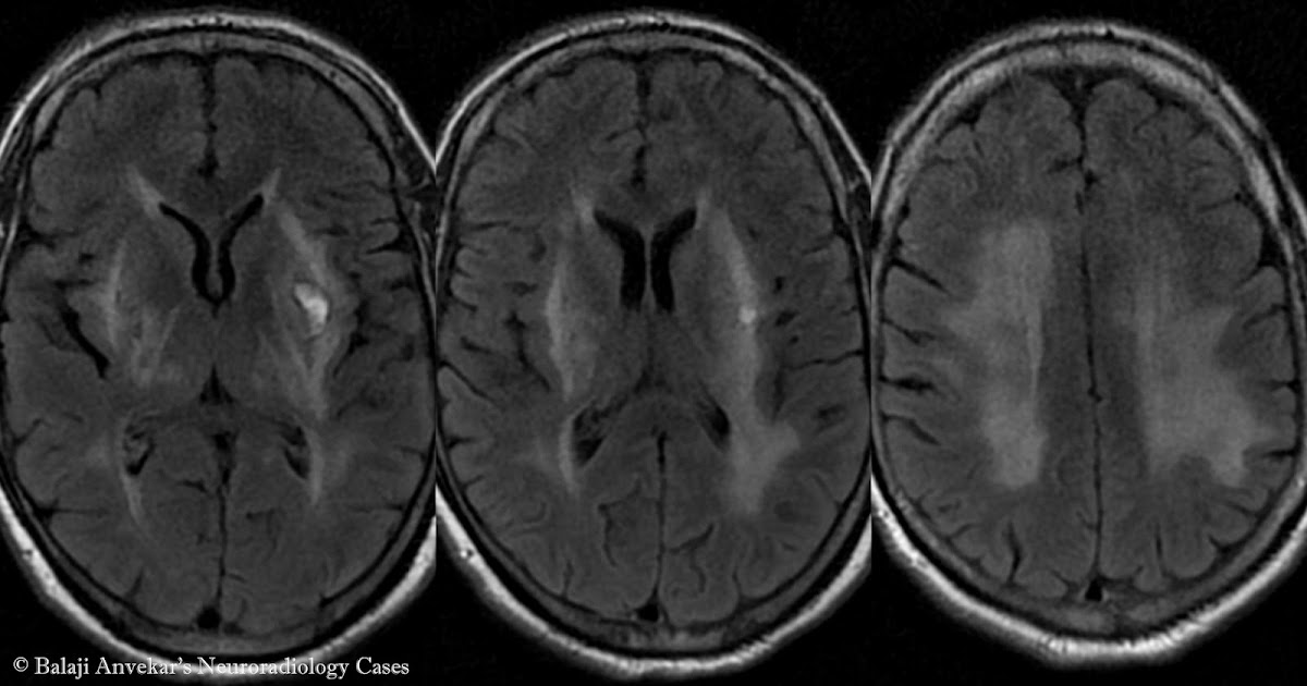 Neuroradiology Cases: Chronic Hypertensive Encephalopathy MRI