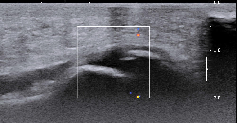 VIETNAMESE MEDIC ULTRASOUND: CASE 466:CHILDREN HEEL PAIN : A SEVER'S ...