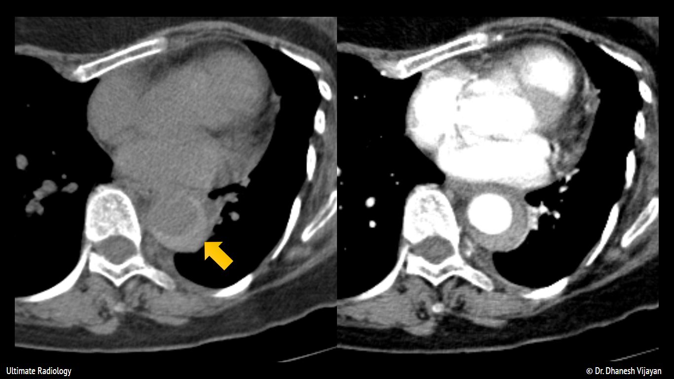 Aortic Dissection Wikipedia