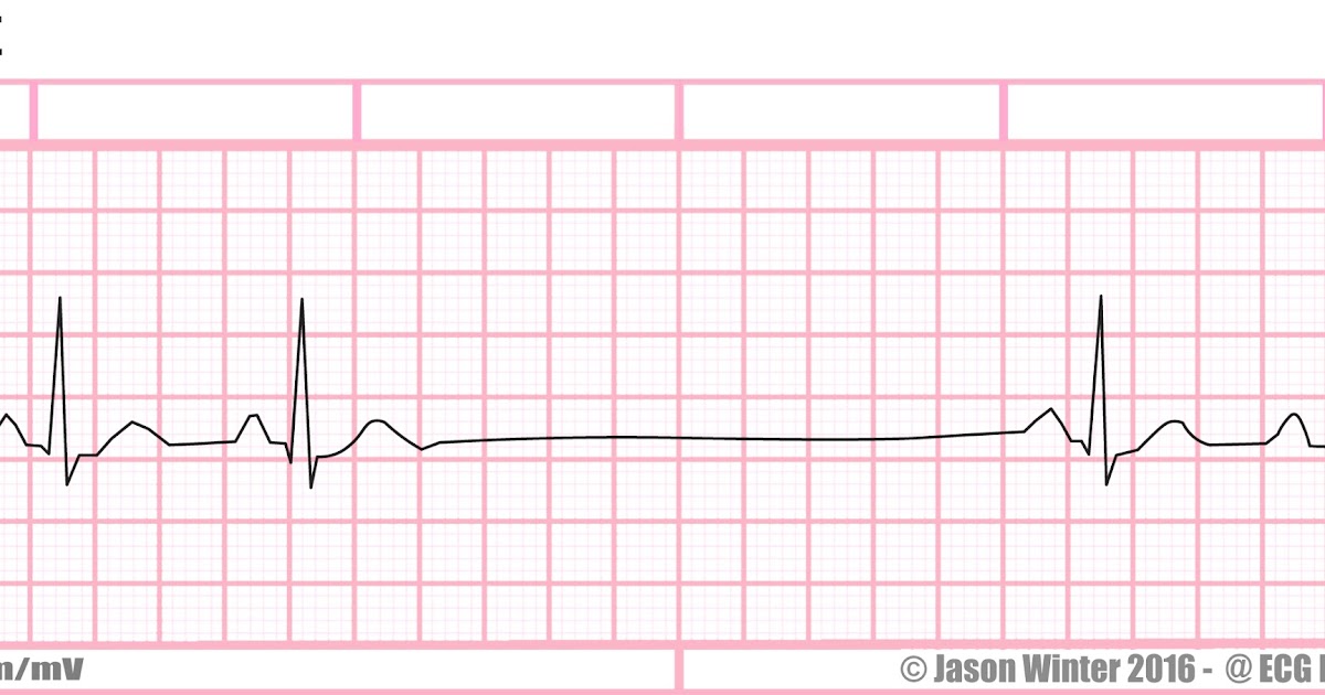 ECG Educator Blog : Sinus Arrest