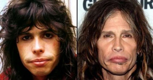 Steven Tyler Plastic Surgery Before and After