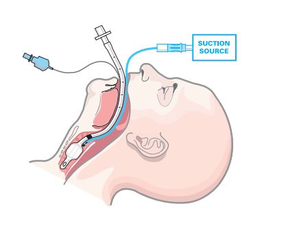 Prepare for Medical Exams : Leak Around Endotracheal tube In A 6 year ...