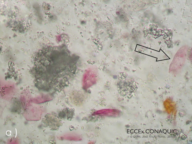 Caso UR-mayo-18 (Enfoque: cristaluria)