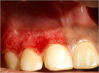 WizDent: Gingival Depigmentation Technique using Bur Abrasion {Step Wise}