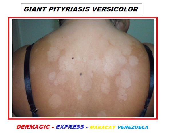 LA PITIRIASIS VERSICOLOR, REVISION /THE PITYRIASIS VERSICOLOR, A REVIEW ...
