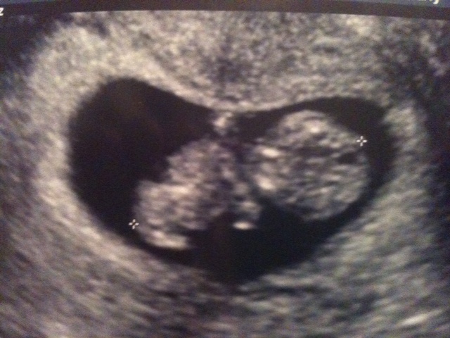 Bumpy Road to Motherhood: Pics of 10 Week Ultrasound
