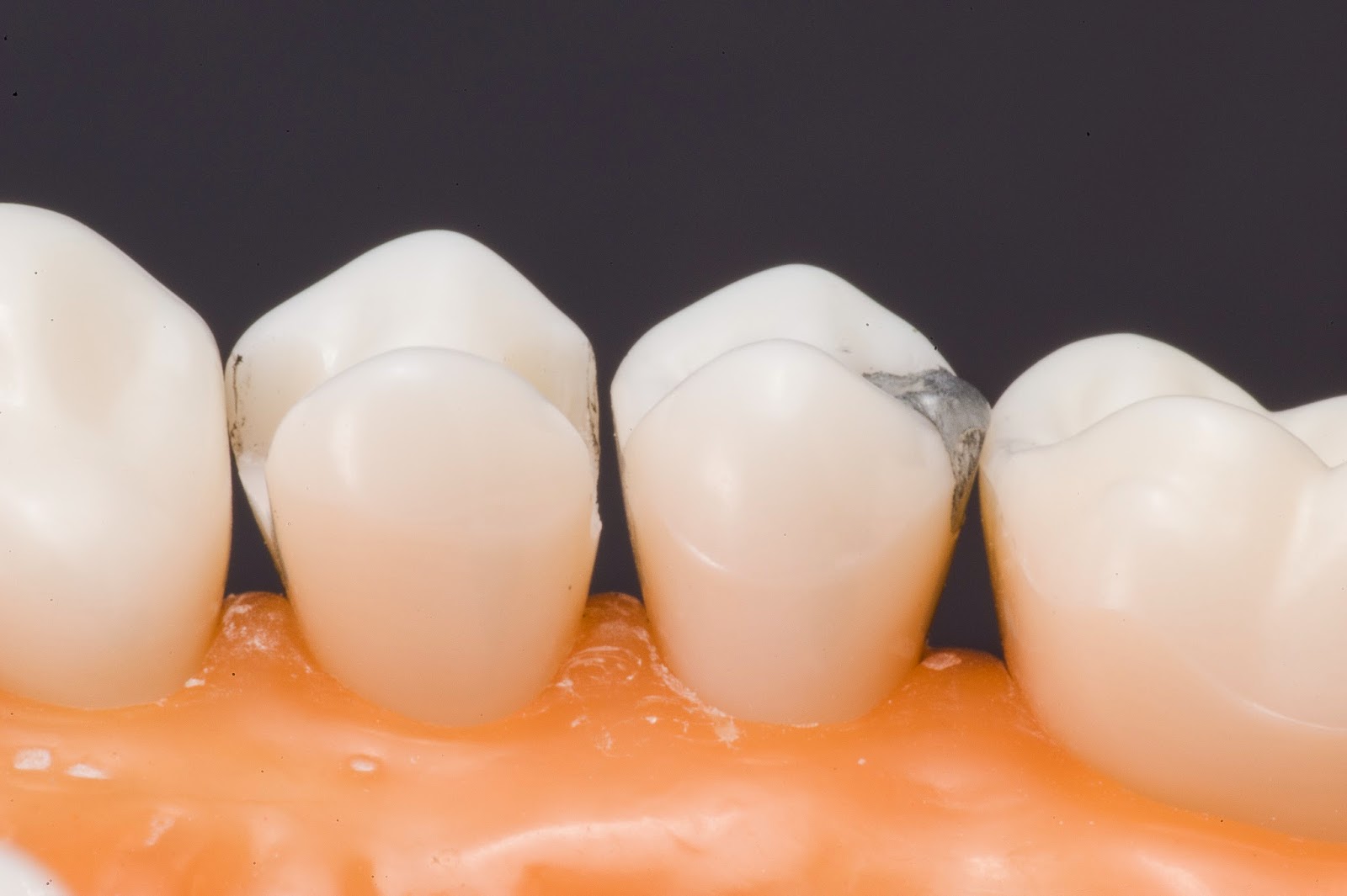 MOD Composite Preparation and Restoration 1: #12 MOD preparation #13 DO ...