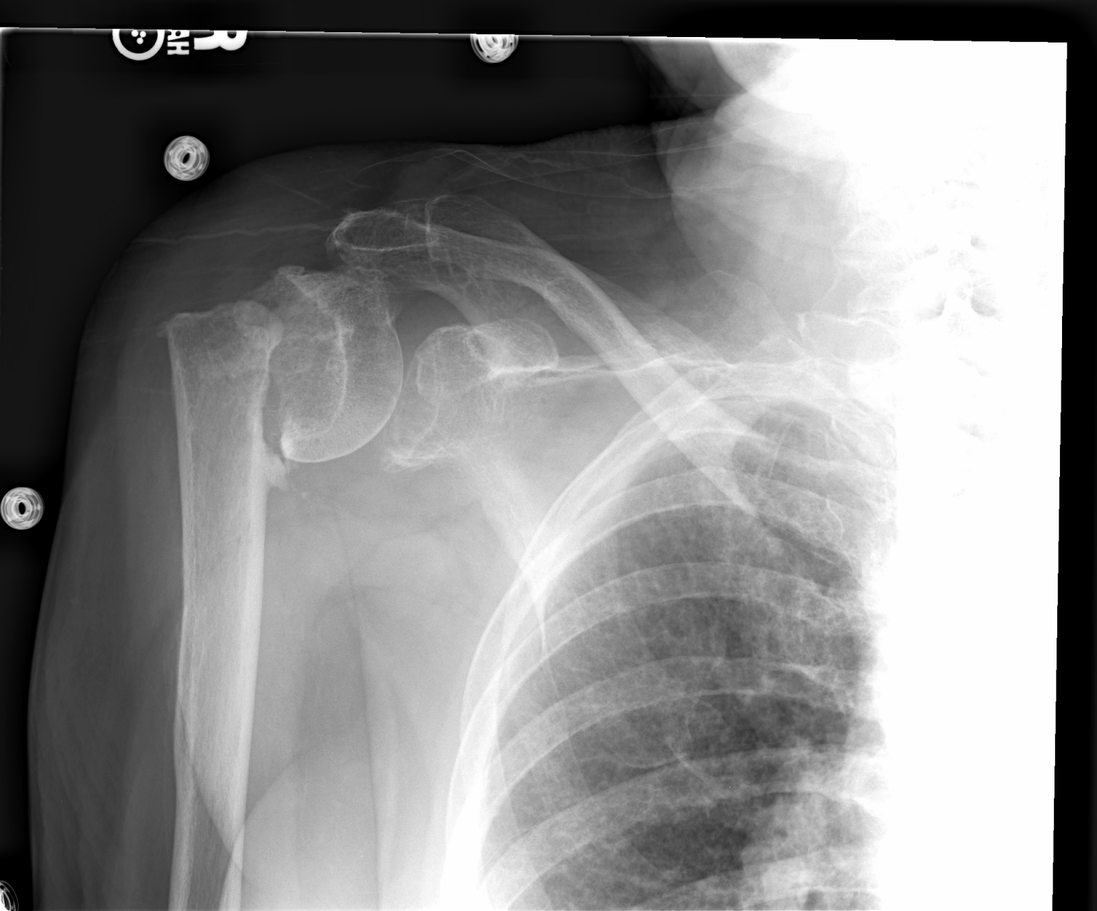 Shoulder and Elbow Surgery: Proximal humerus nonunion in the elderly ...