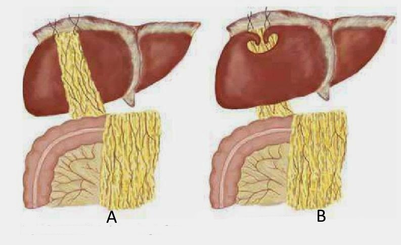 Revision Casos De Cirugia General: QUISTE HEPATICO HIDATIDICO ...