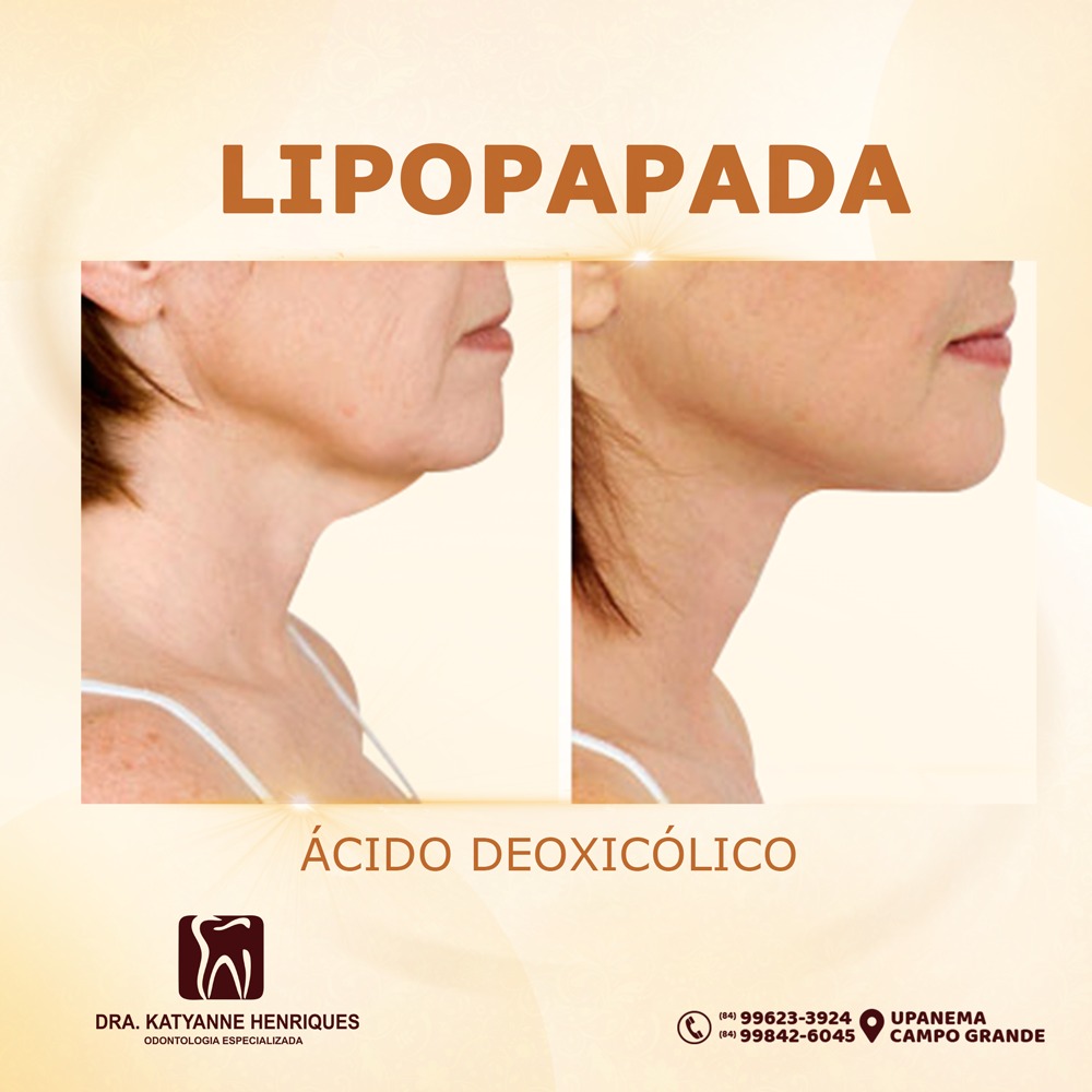 UPANEMA NEWS: Lipopapada com Dra. Katyanne Henriques