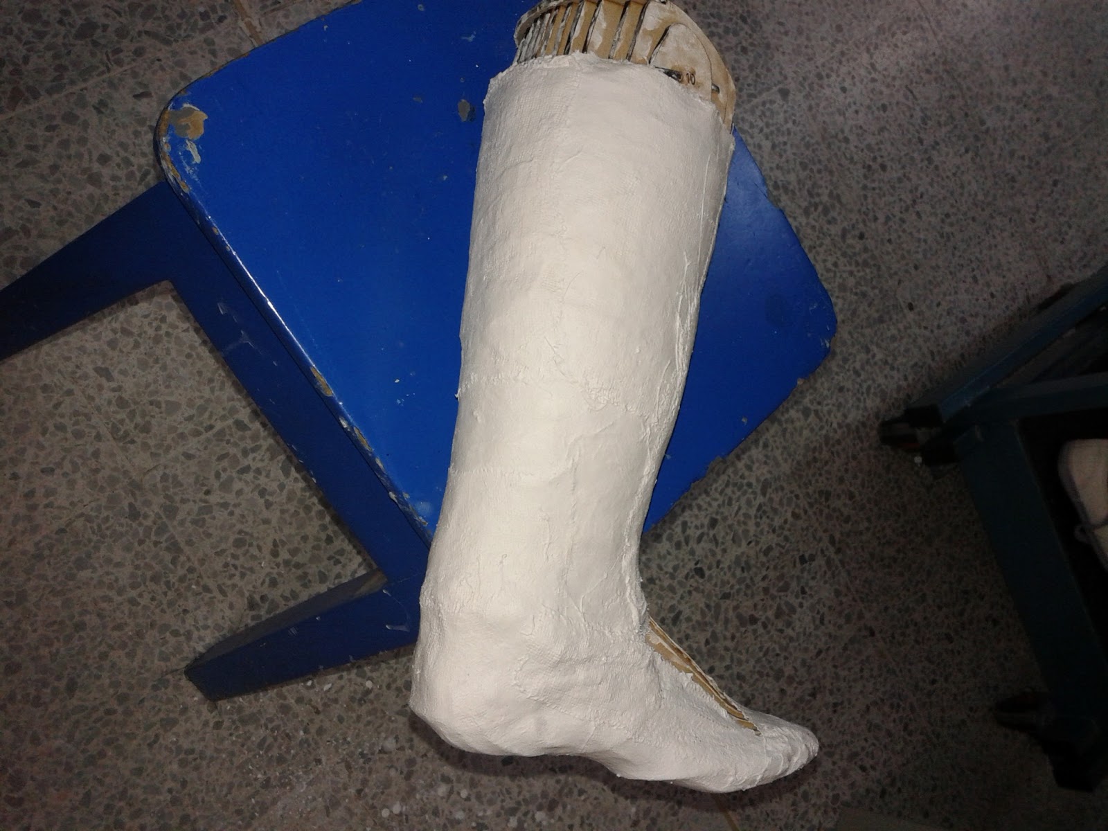 Diseño de Ortesis para pie caído: MOLDE EN YESO