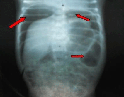 Enfermeras posturno: Perforación Intestinal