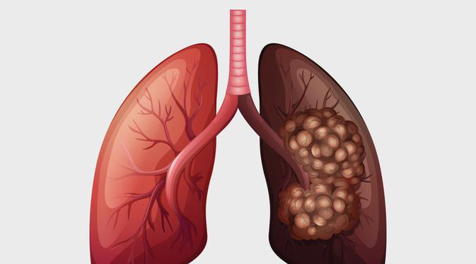 Infeksi penyakit paru-paru : Cara mengobati infeksi radang paru ...