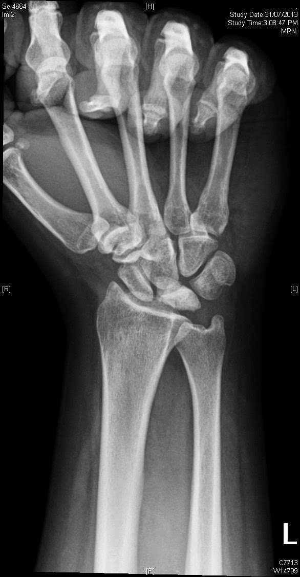 Joint Preservation and Replacement : Painful left wrist in a rt handed ...