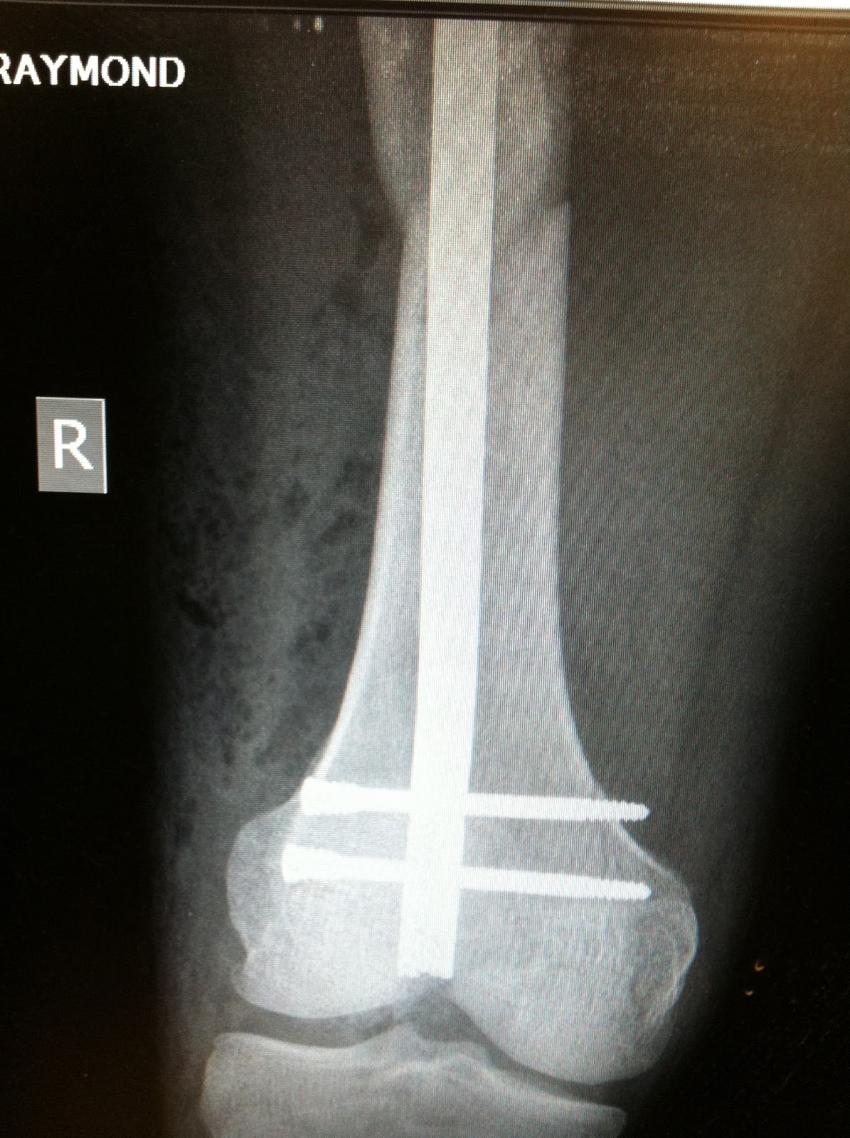 Venture Forth: The SIGN Nail